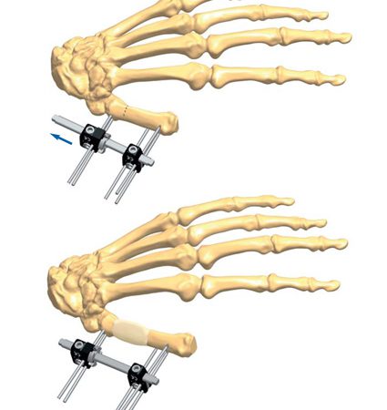 Hand lengthening treatments | Orthofix ABS