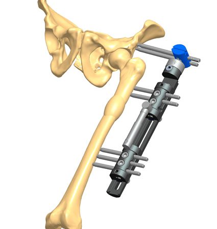 Pediatric hip fusion with concomitant femoral lengthening | Orthofix ABS