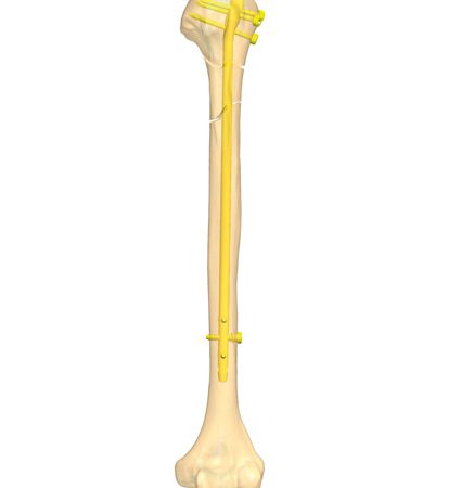 Humerus fracture treatments | Orthofix ABS