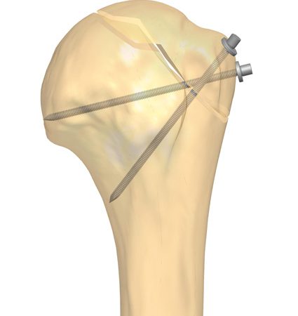 Humerus fracture treatments | Orthofix ABS
