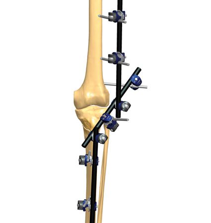 Knee fracture treatments | Orthofix ABS