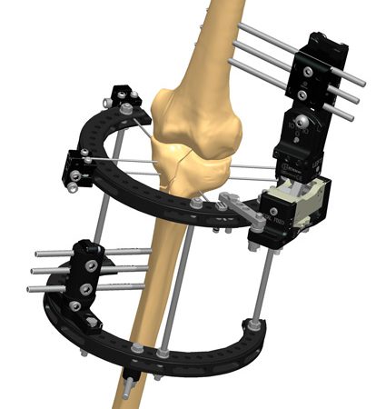 Knee fracture treatments | Orthofix ABS