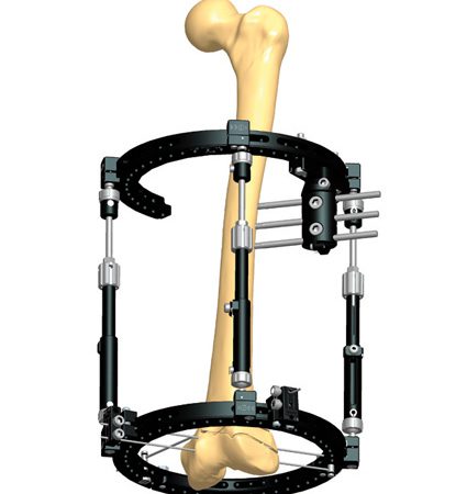 Knee fracture treatments | Orthofix ABS