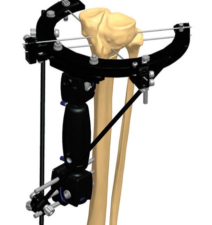 Knee fracture treatments | Orthofix ABS