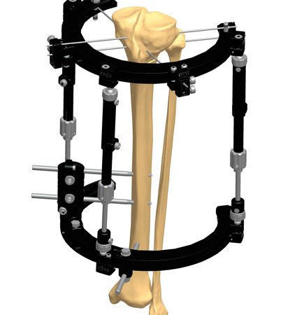 Knee fracture treatments | Orthofix ABS