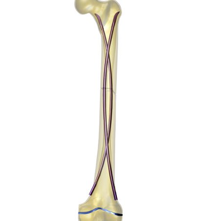 Pediatric femur fracture recovery | Orthofix ABS