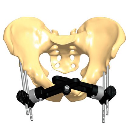 Fractured pelvis recovery | Orthofix ABS