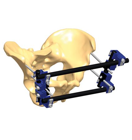 Fractured pelvis recovery | Orthofix ABS
