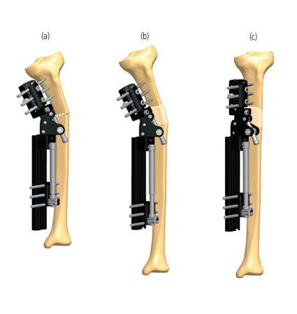 Correction of tibial deformity with lengthening | Orthofix ABS