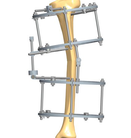 Correction of pediatric tibia deformity | Orthofix ABS