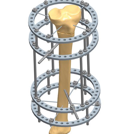 Tibia bone fracture treatment | Orthofix ABS
