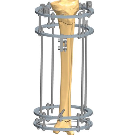 Tibia bone fracture treatment | Orthofix ABS