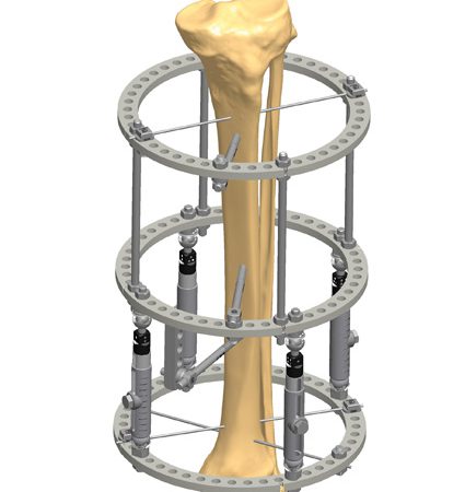 Tibia bone fracture treatment | Orthofix ABS