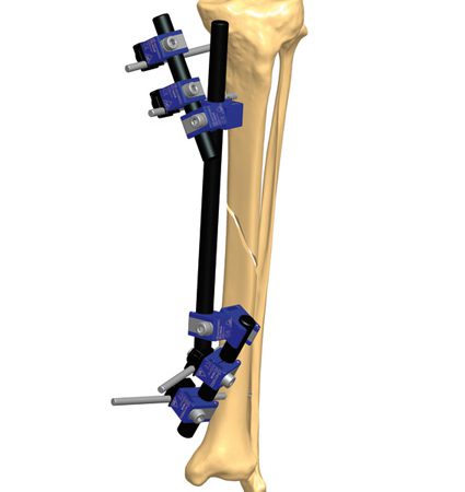 Tibia bone fracture treatment | Orthofix ABS
