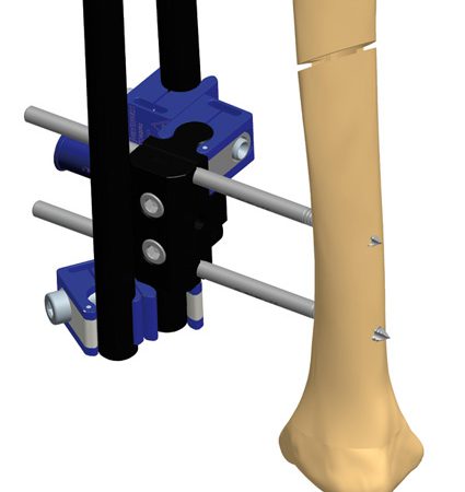 Tibia bone fracture treatment | Orthofix ABS