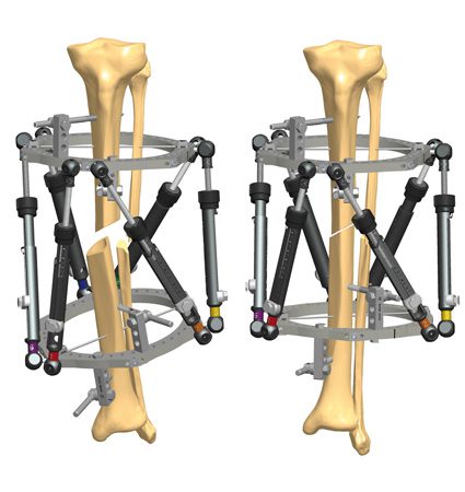 Tibia bone fracture treatment | Orthofix ABS