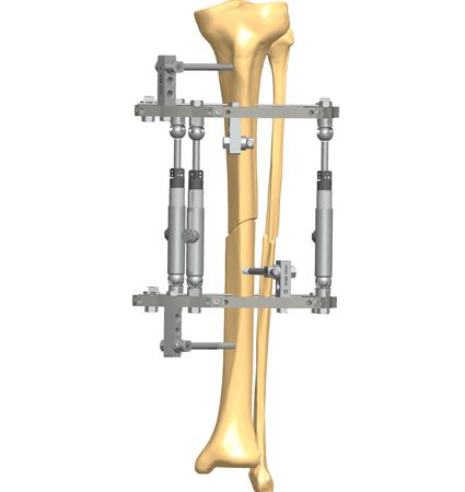 Tibia bone fracture pediatric treatment | Orthofix ABS