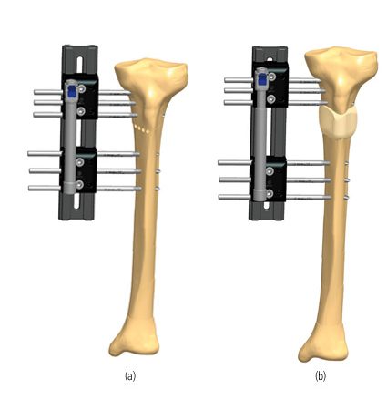 Tibia lengthening treatment | Orthofix ABS