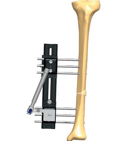 Tibia lengthening treatment | Orthofix ABS