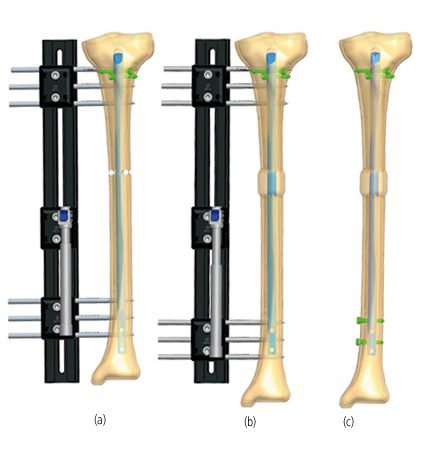 Tibia lengthening treatment | Orthofix ABS