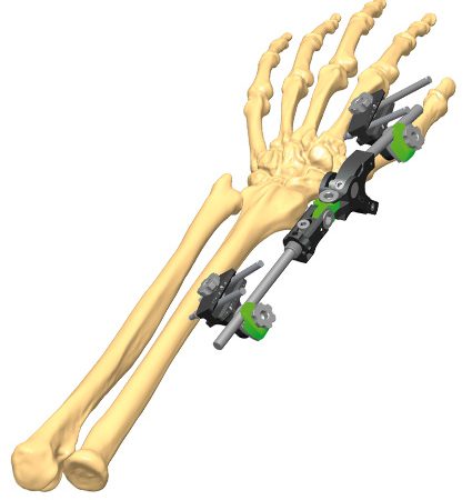 Wrist fracture treatments | Orthofix ABS