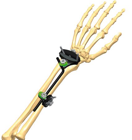 Wrist fracture treatments | Orthofix ABS