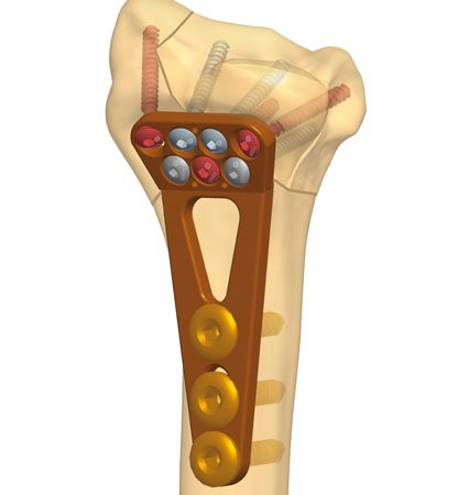 Wrist fracture treatments | Orthofix ABS