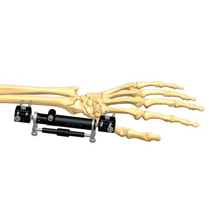 Wrist fracture treatments | Orthofix ABS
