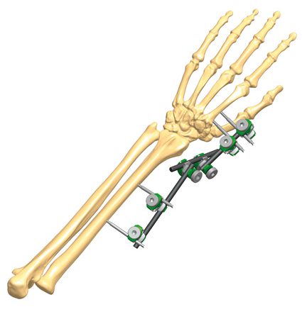 Wrist fracture treatments | Orthofix ABS