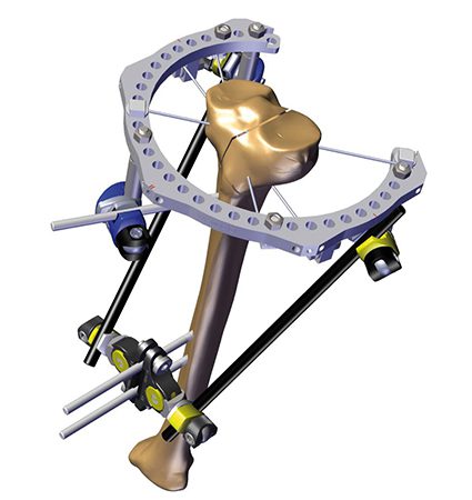 Tibia bone fracture pediatric treatment | Orthofix ABS