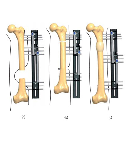 3A51 for Major soft tissue defects - Orthofix