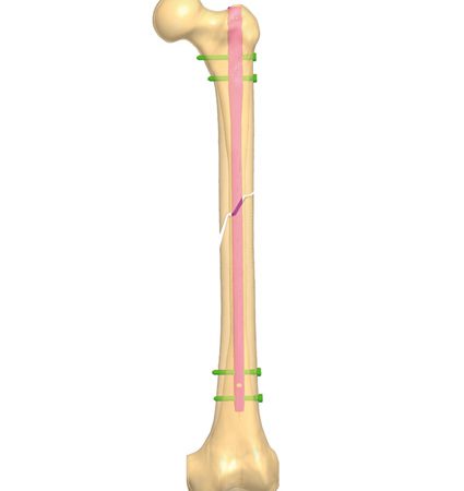 Femur fracture recovery | Orthofix ABS