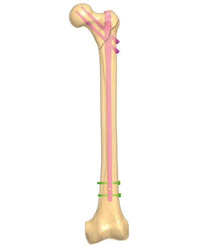 3A10 for Fractures - Orthofix