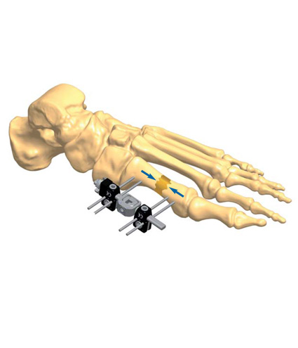 3E11 for Non union - Orthofix