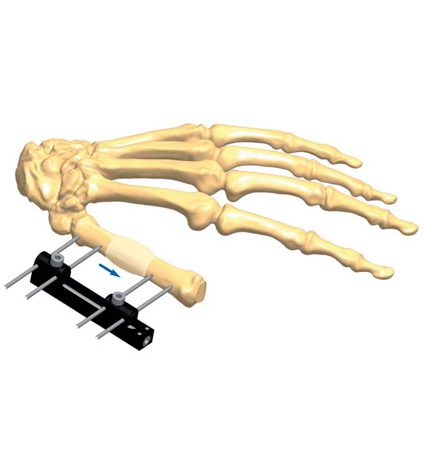 Hand lengthening treatments | Orthofix ABS