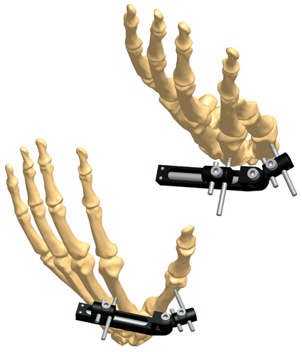 1A13 for Soft tissue - Orthofix