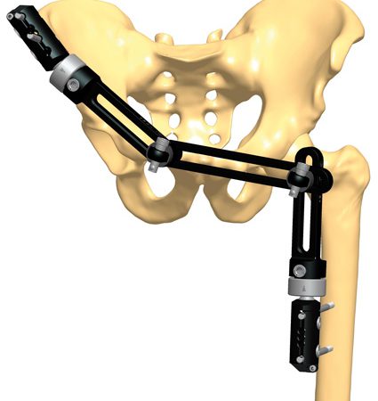 Acetabular fracture treatments | Orthofix ABS