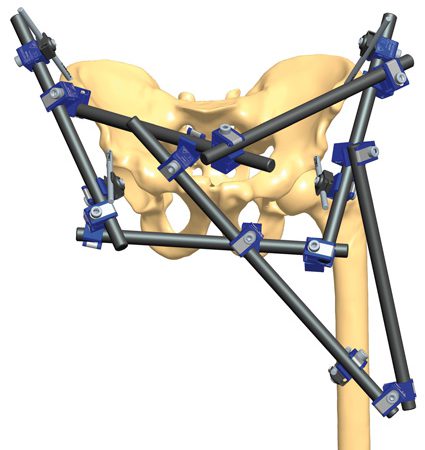 Acetabular fracture treatments | Orthofix ABS