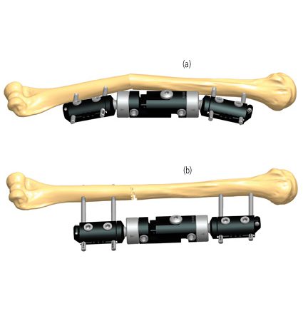 Humerus deformity treatments | Orthofix ABS