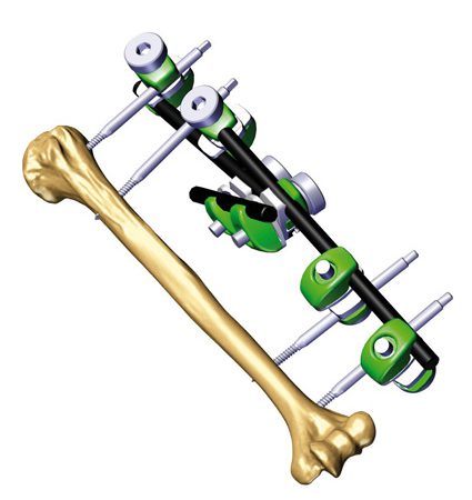 Pediatric humerus fracture treatments | Orthofix ABS