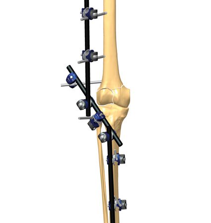Knee fracture pediatric treatments | Orthofix ABS