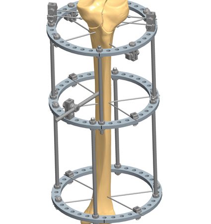 Knee fracture pediatric treatments | Orthofix ABS