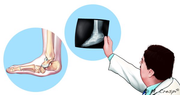 Foot and Ankle Charcot Reconstruction with External Fixation - Orthofix