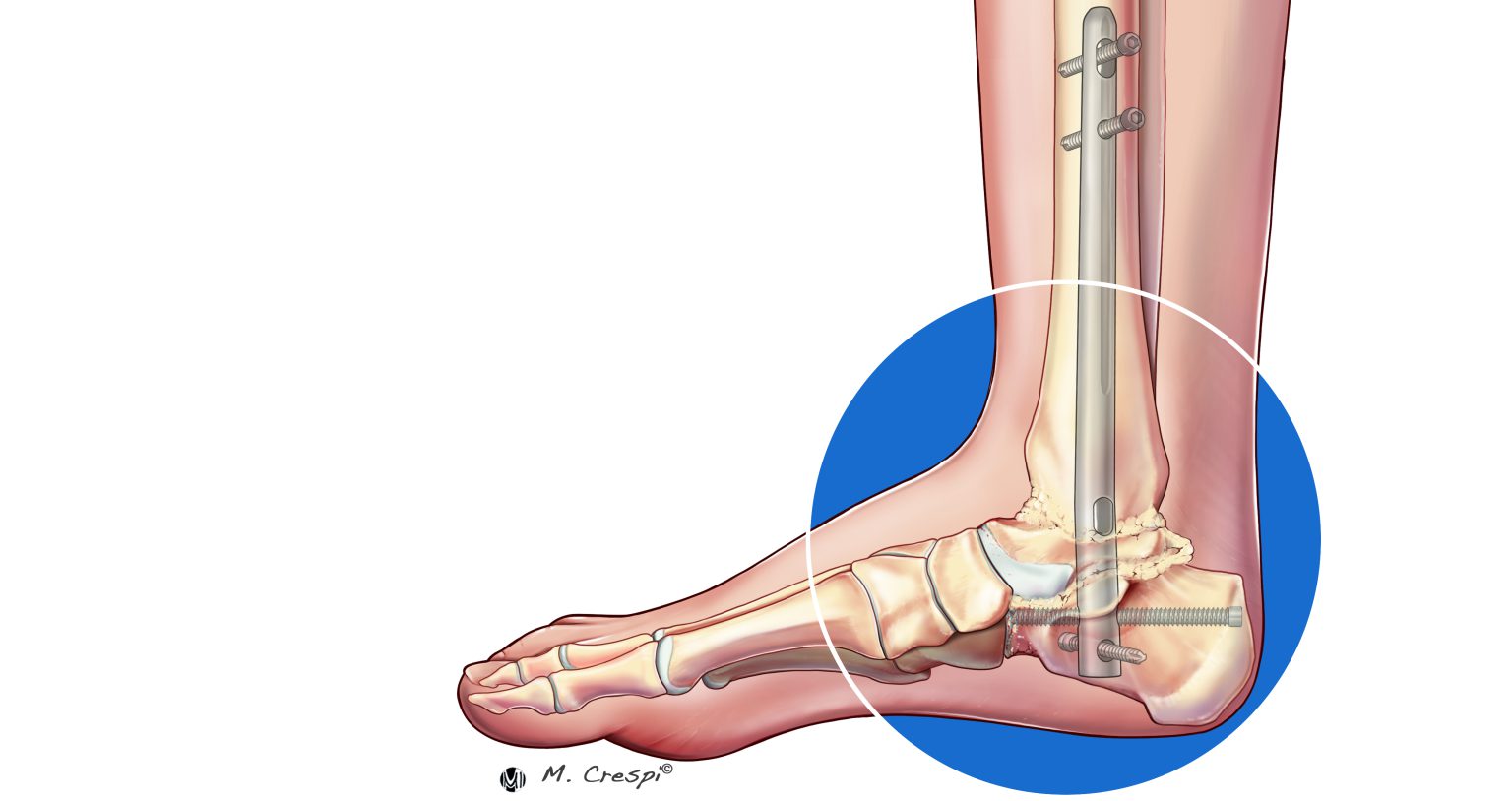 Surgical Management of the Charcot Ankle - Orthofix