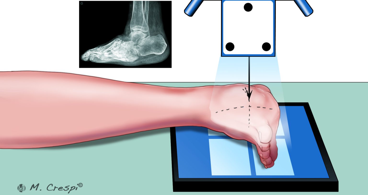Foot And Ankle Charcot Reconstruction With External Fixation Orthofix