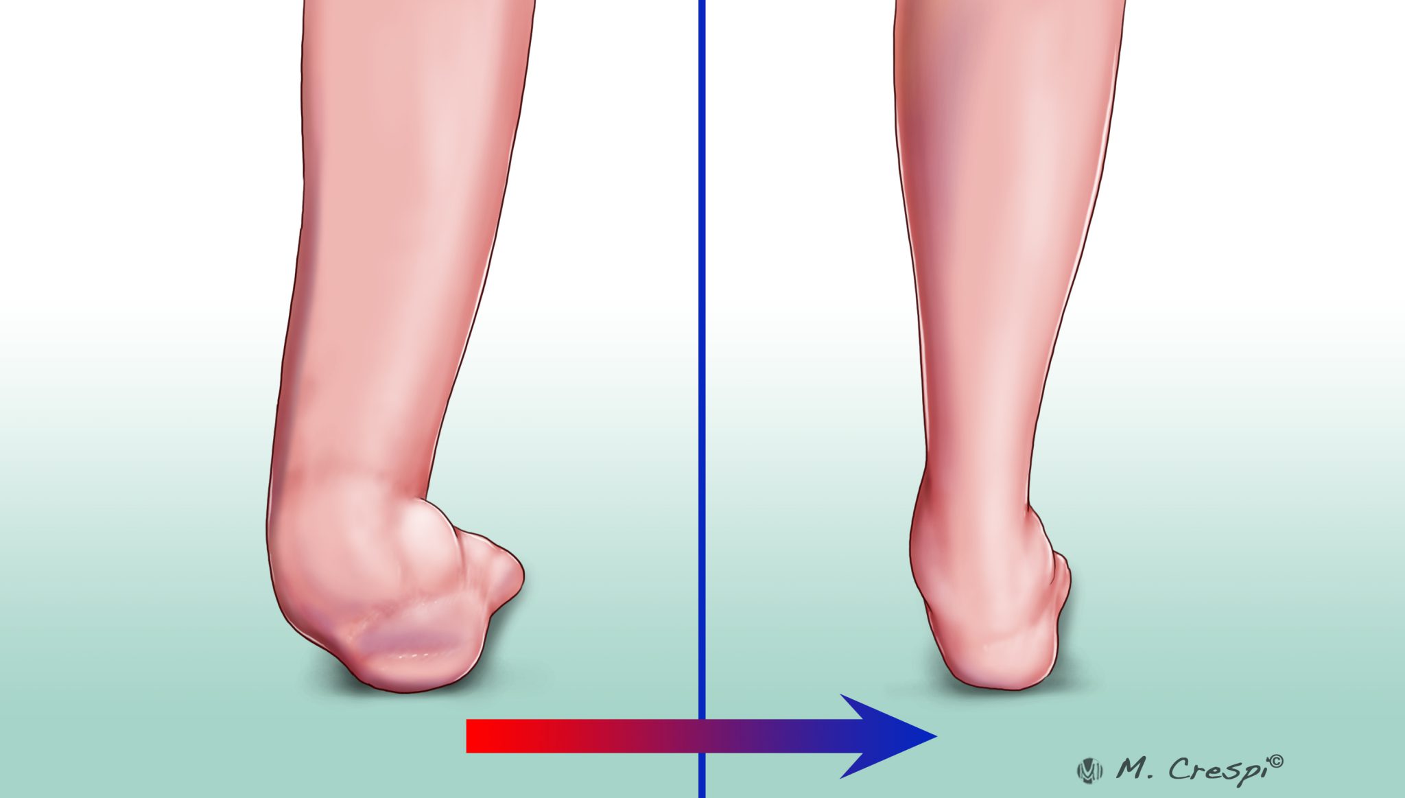 Charcot Surgical Reconstruction - Orthofix