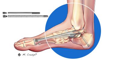 Foot and Ankle Charcot Reconstruction with External Fixation - Orthofix