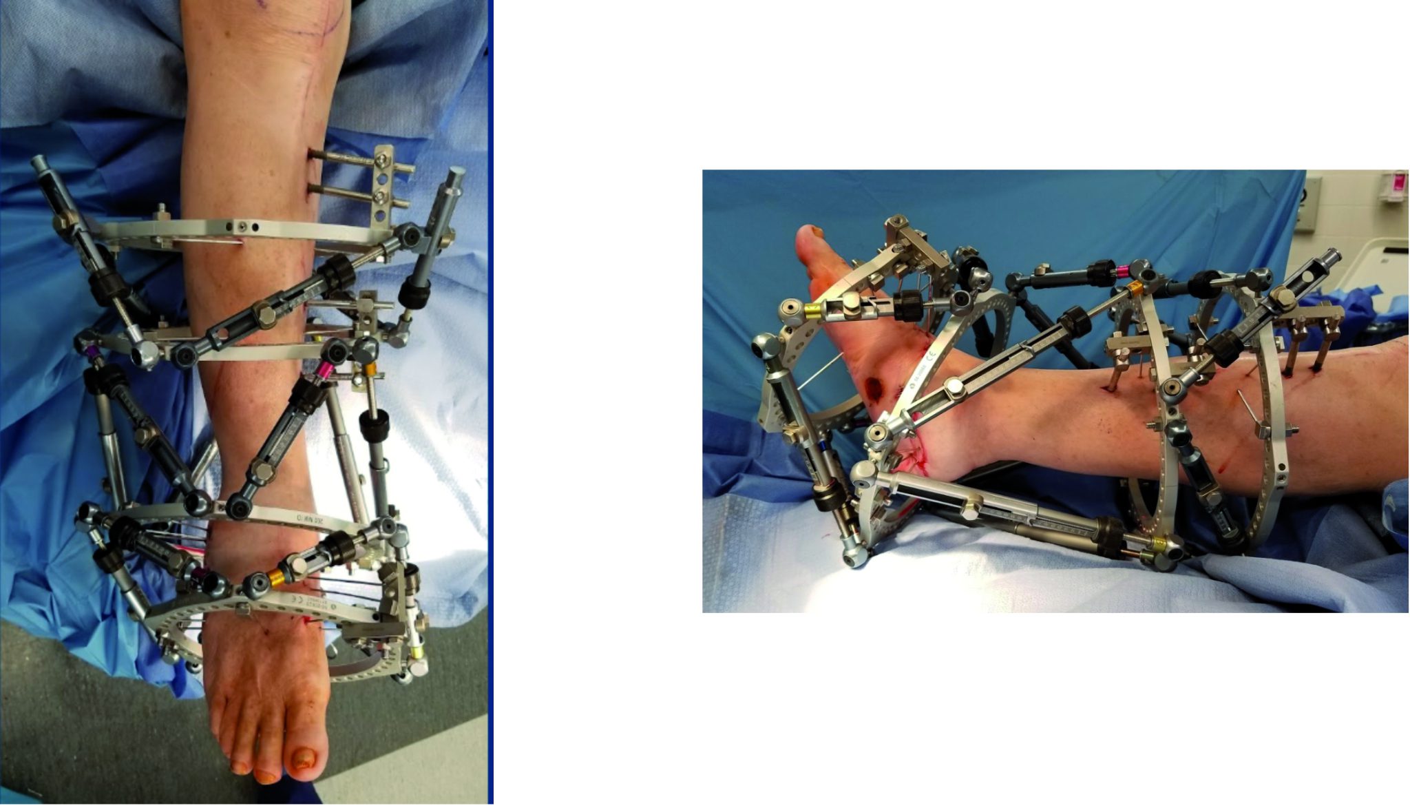 Foot and Ankle Charcot Reconstruction with External Fixation - Orthofix