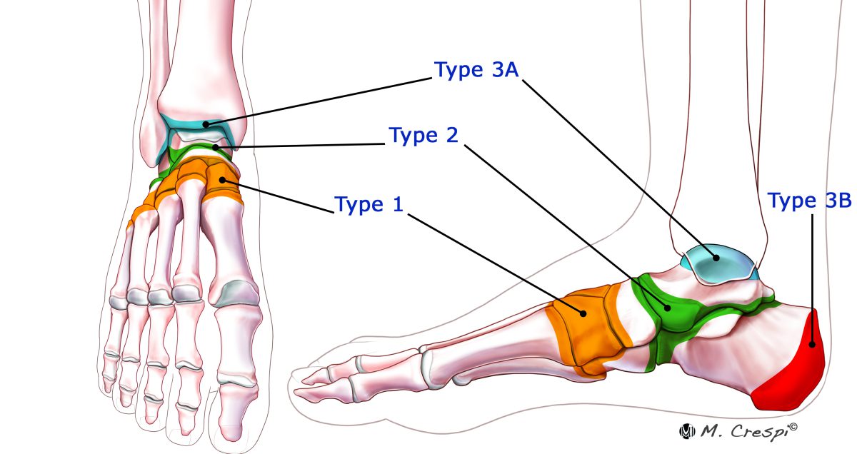 The Experts’ Definition of Diabetic Charcot Foot - Orthofix