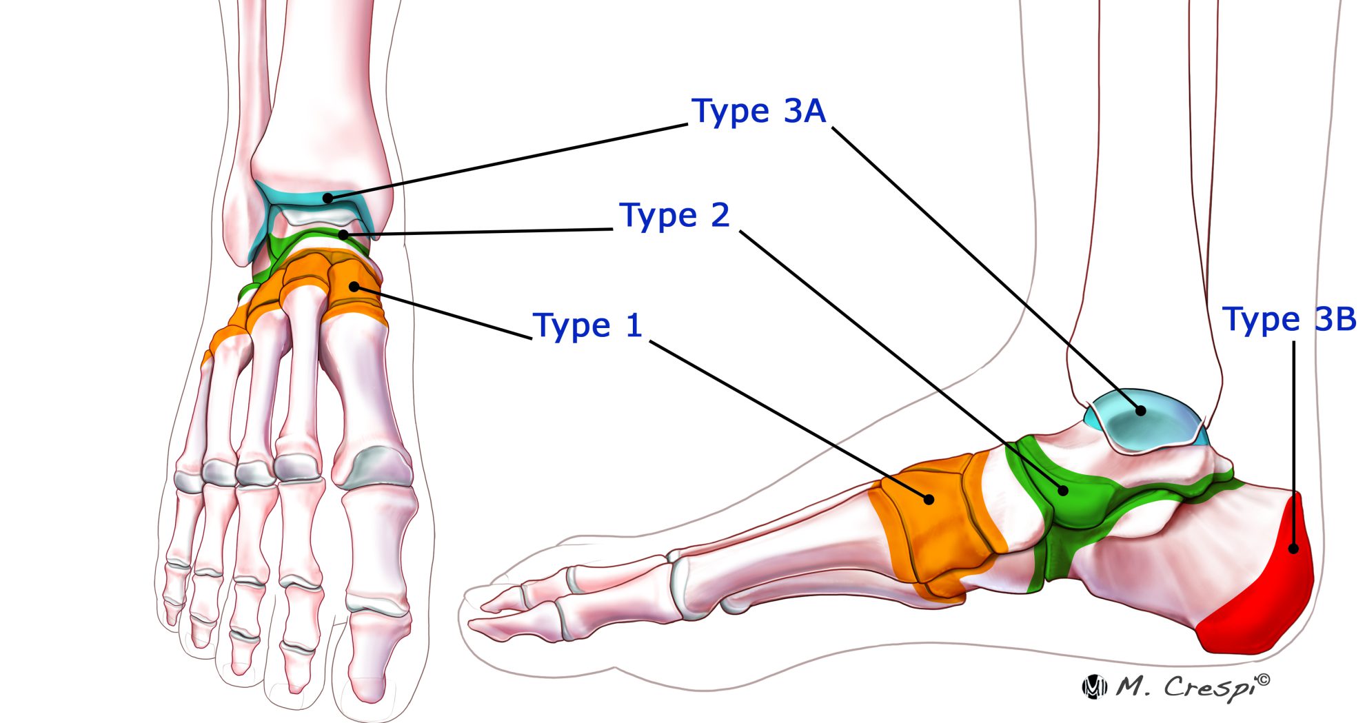 The Experts’ Definition of Diabetic Charcot Foot - Orthofix